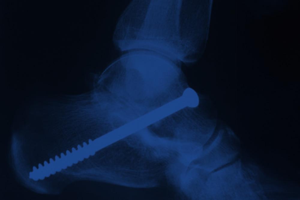 Subtalar Joint Fusion Recovery Time Procedure Footankleaz Subtalar Joint Fusion Recovery Time Procedure Footankleaz
