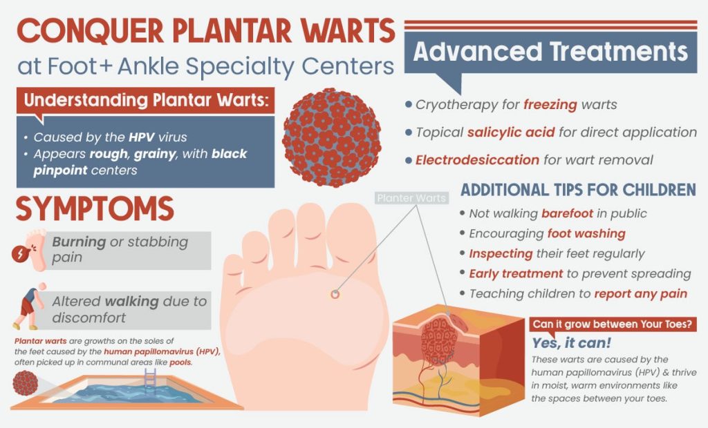 Plantar Wart Treatment in Phoenix, AZ | Foot + Ankle Specialty Centers