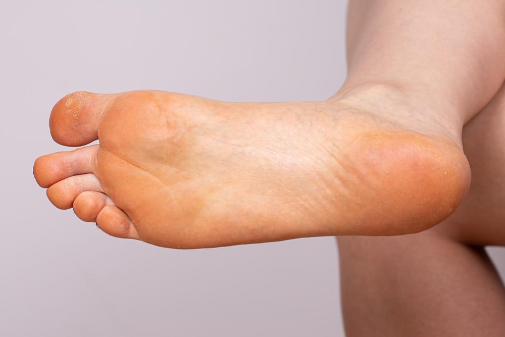 Carotenosis Feet