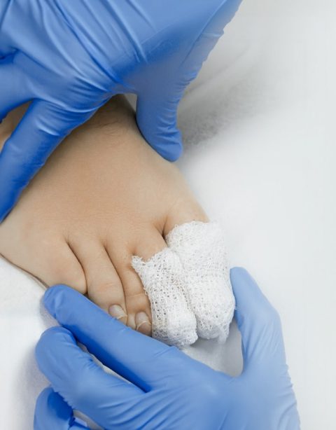 Diabetic Foot Ulcer Treatment, Medication, Ointment, Antibiotics